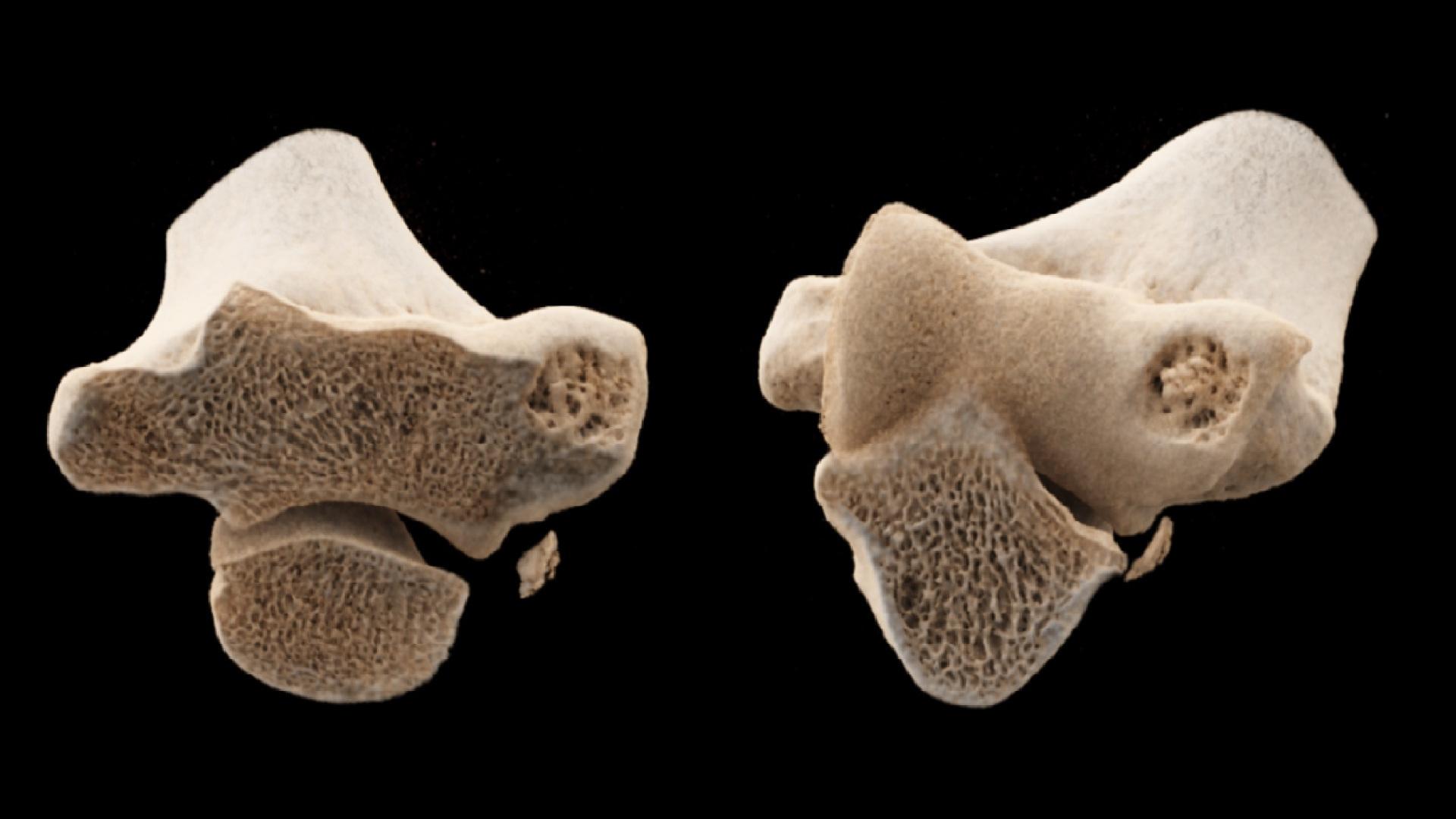 Osteochondritis dissecans of the capitellum - Siemens Healthineers