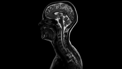 MRI for Alzheimer's disease - Siemens Healthineers USA