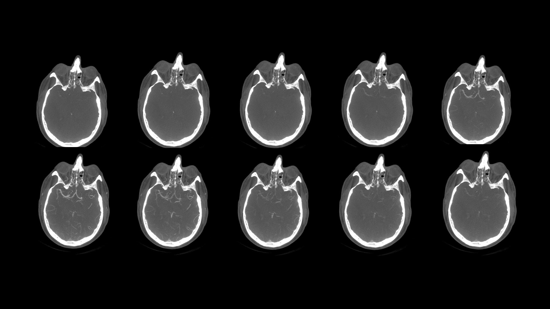 ARTIS icono for neuro interventions - Siemens Healthineers USA