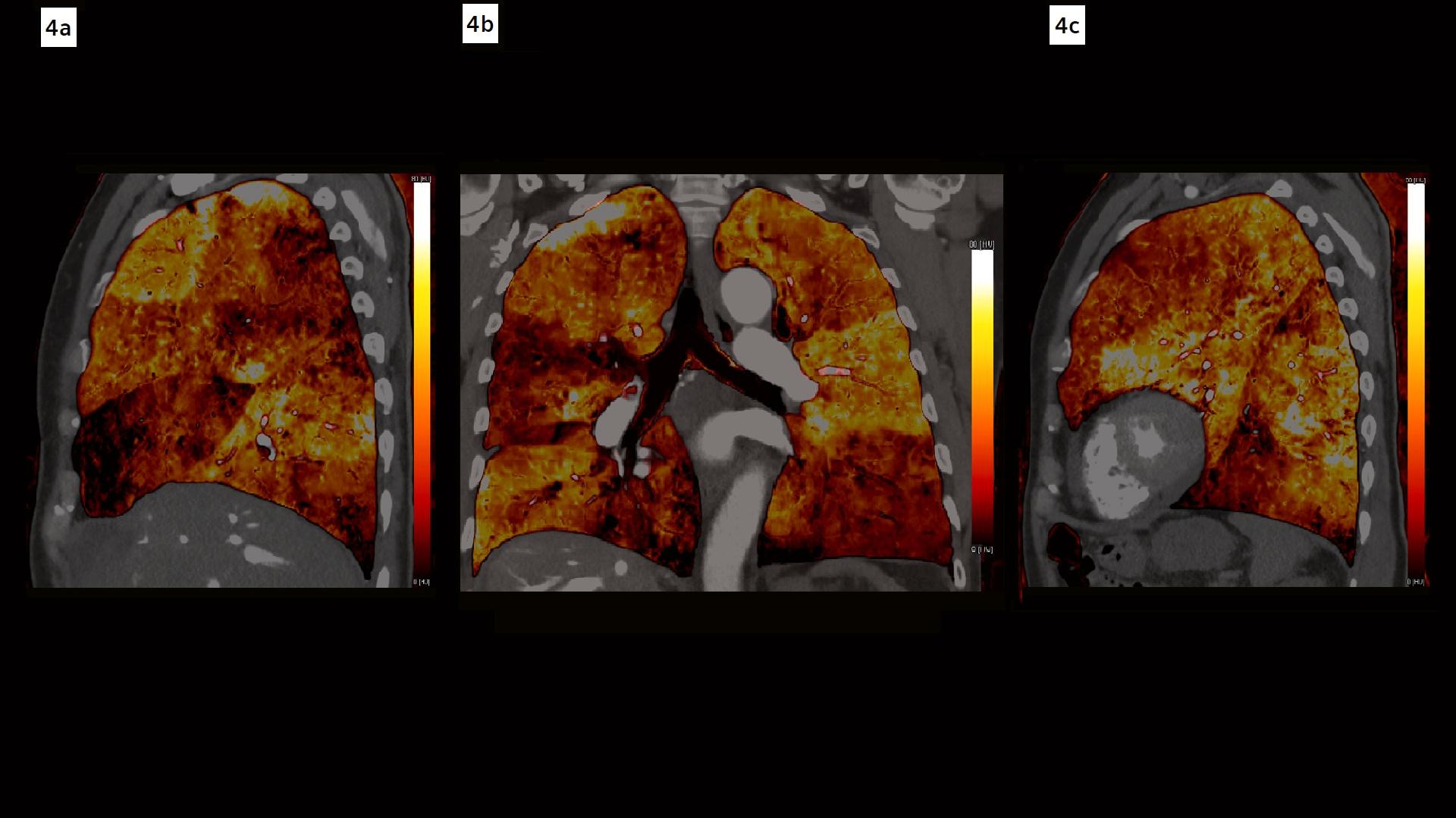 Chronic thromboembolic pulmonary hypertension diagnosed after COVID-19 ...