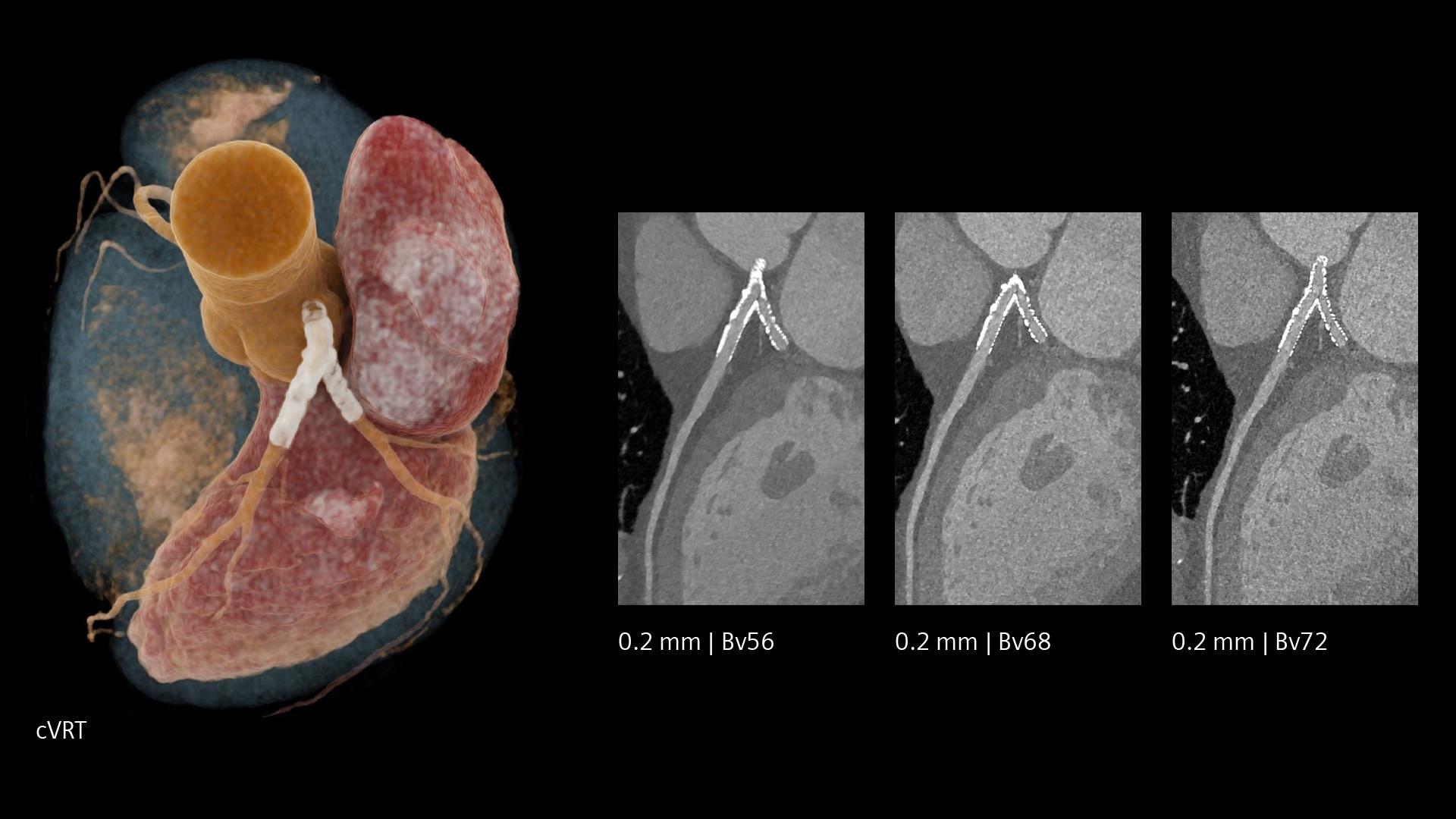 PCCT cardiovascular imaging - Siemens Healthineers