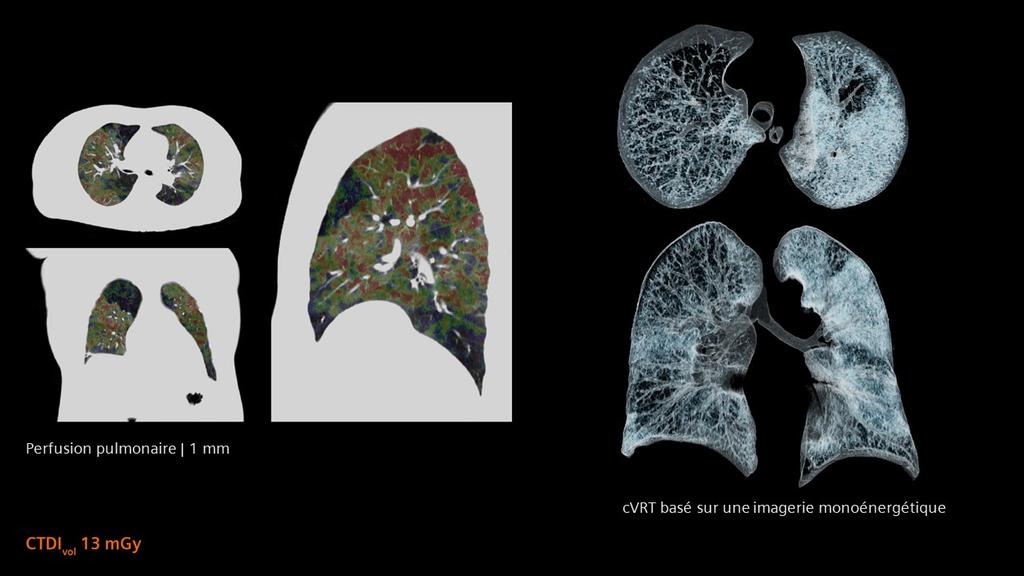 NAEOTOM Alpha - Applications pulmonaires - Siemens Healthineers France