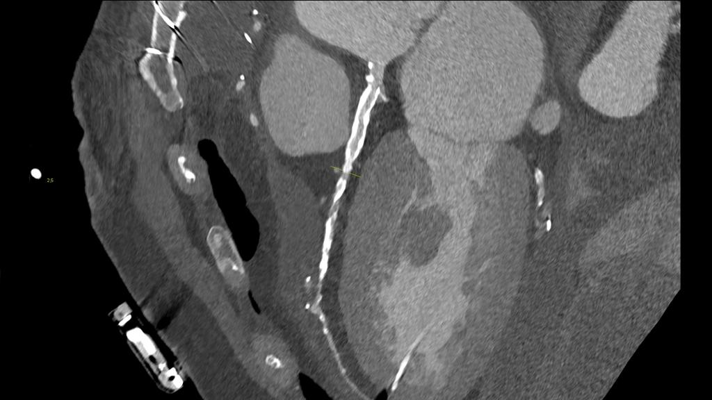NAEOTOM Alpha photon-counting CT scanner - Siemens Healthineers Canada
