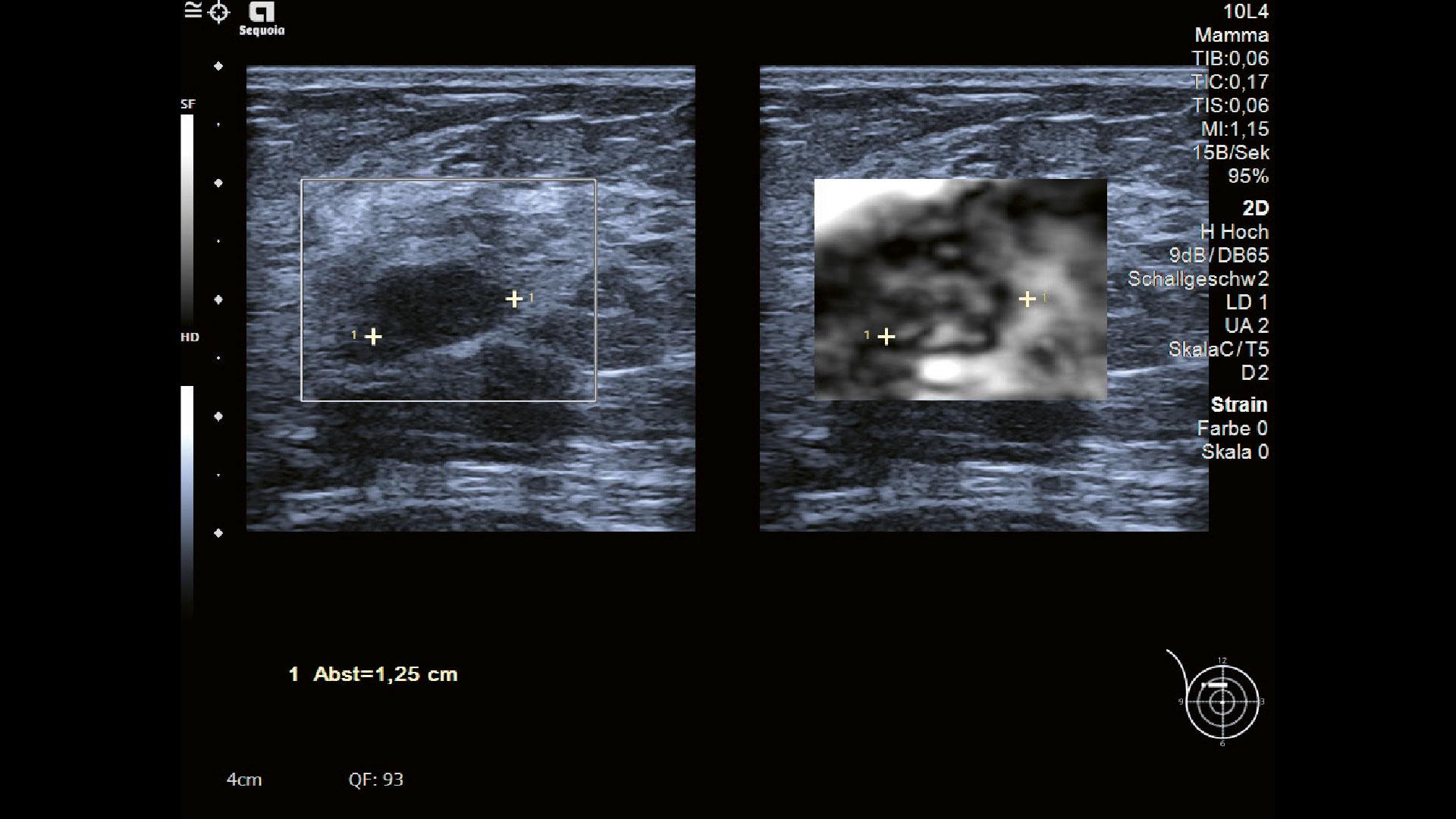 Casos prácticos de ultrasonido de mama - Siemens Healthineers Latinoamérica