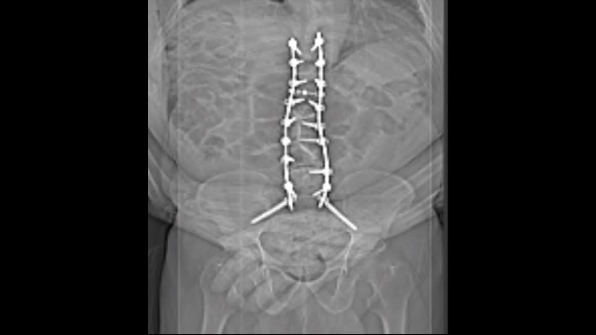 SPECT/CT imaging in the evaluation of pain following spinal fusion ...