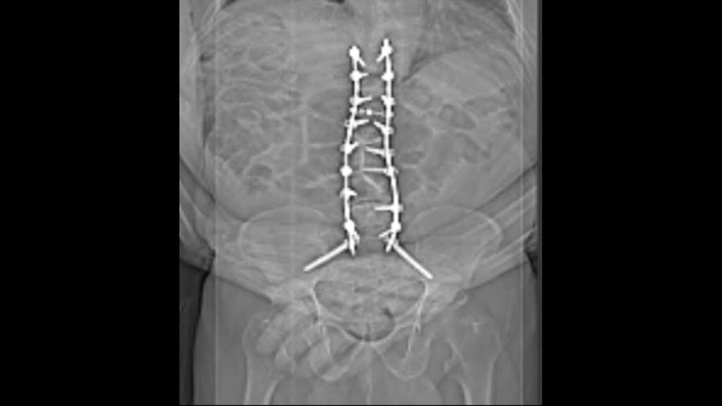 SPECT/CT imaging in the evaluation of pain following spinal fusion ...
