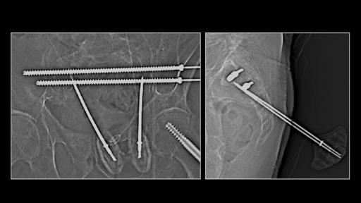 Interventional Oncology Procedures - Siemens Healthineers