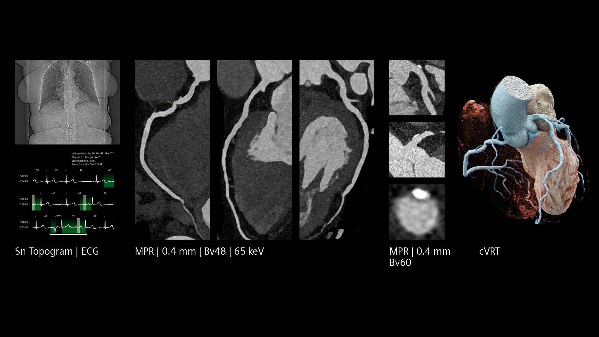 PCCT cardiovascular imaging - Siemens Healthineers