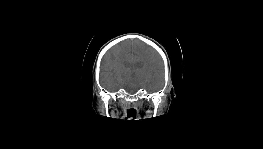 Advanced stroke management and patient care - Siemens Healthineers