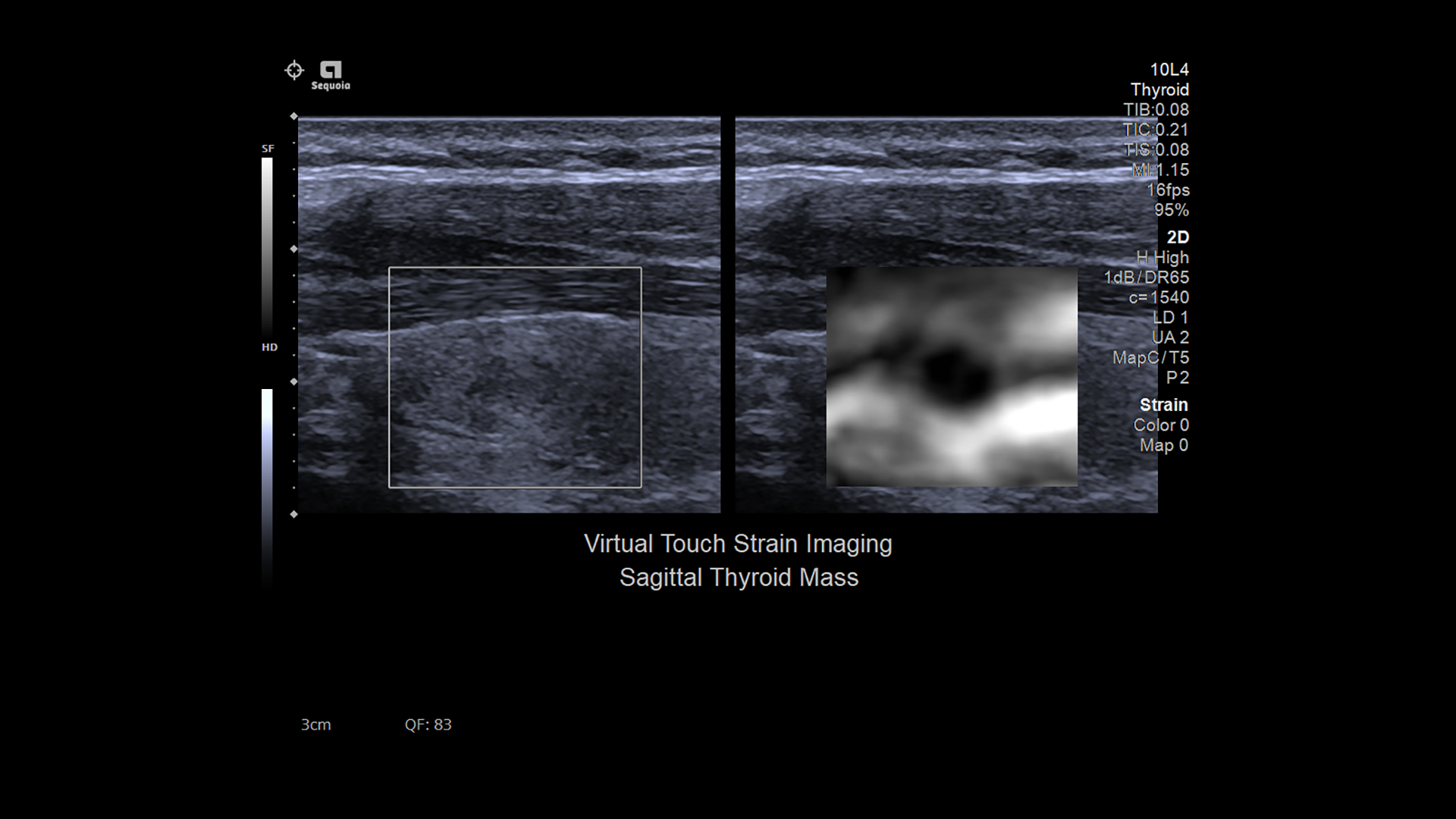 ACUSON Sequoia Ultrasound System - Siemens Healthineers