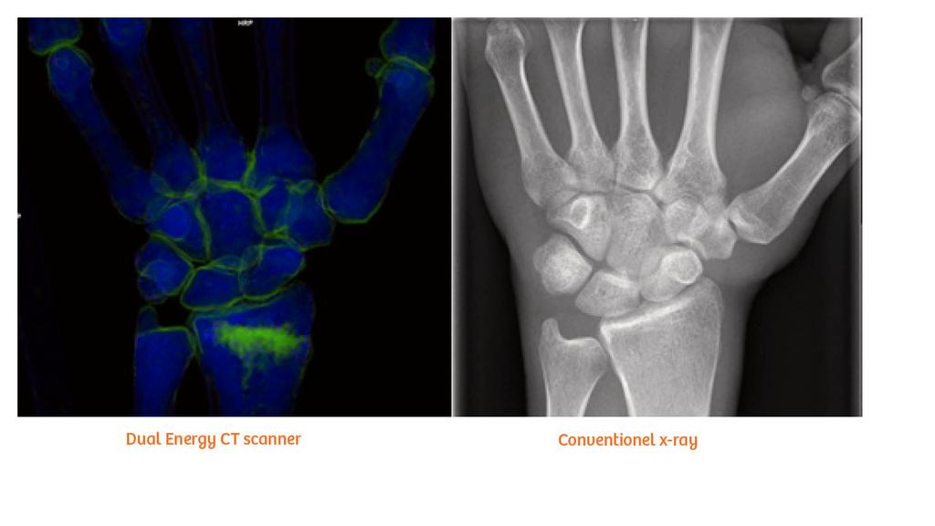 Use of advanced CT scanners can improve diagnosing of wrist fracture ...
