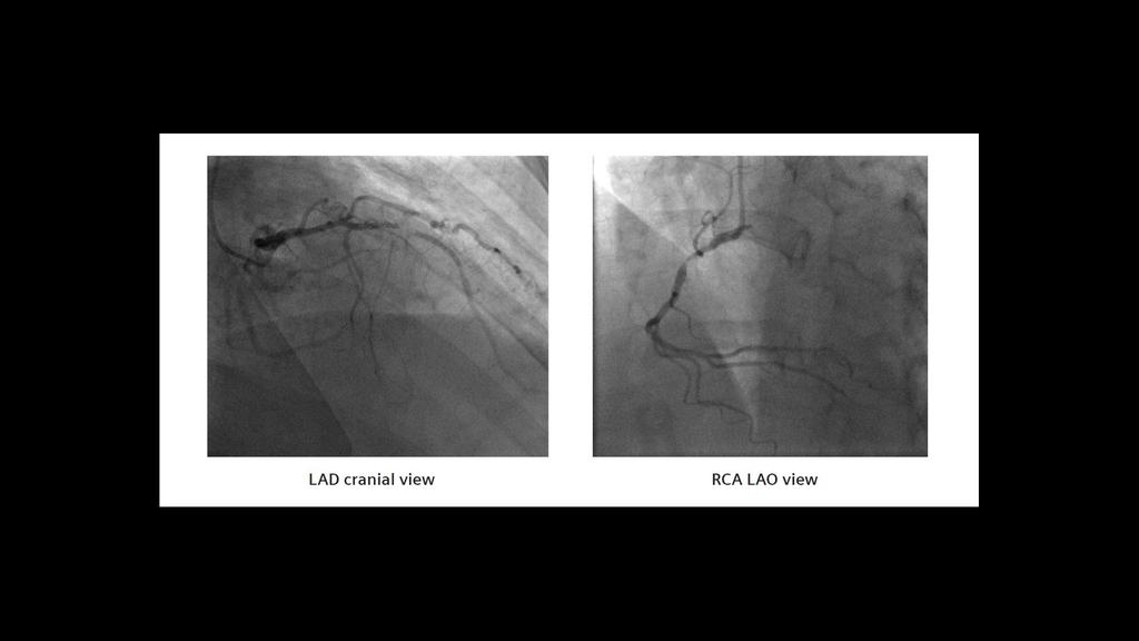 PET/CT delineation of multivessel coronary artery disease and post ...