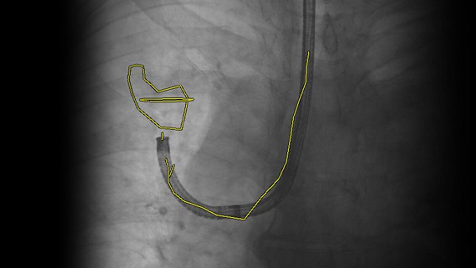 Endobronchial Interventions in the Hybrid OR - Siemens Healthineers