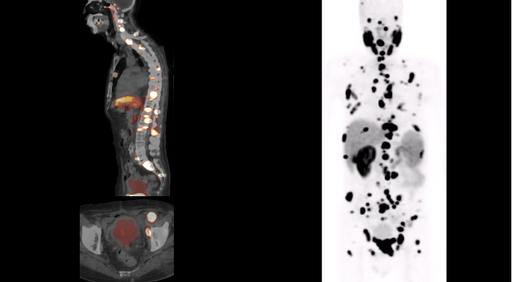 Cancer Prostate Theranostics - A revolution in the Nuclear Medicine field