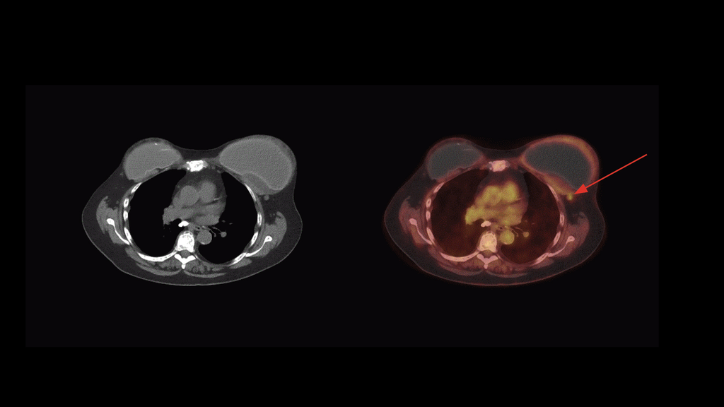 18F FES PET/CT imaging in recurrent metastatic invasive lobular breast ...