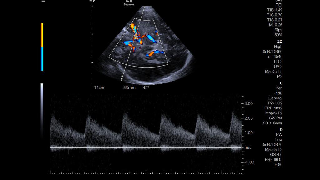 ACUSON Sequoia Ultrasound Machine for Pediatrics - Siemens Healthineers