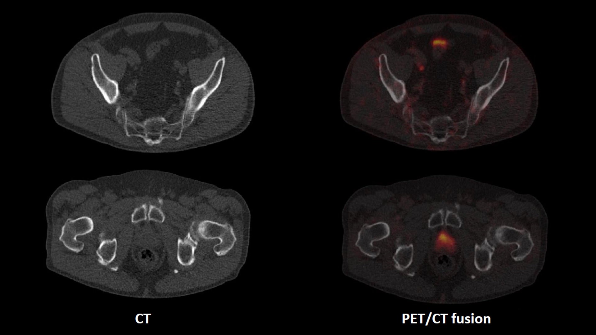Biograph Vision PET/CT Scanner - Siemens Healthineers