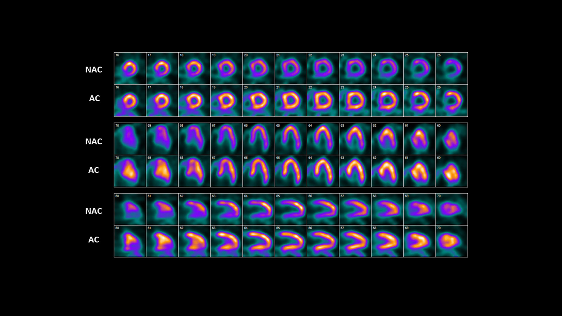 Fully integrated Symbia Pro.specta SPECT/CT - Siemens Healthineers USA