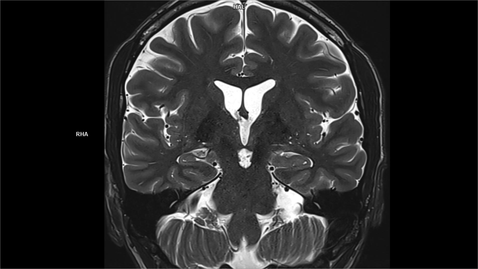 Coronal T2 tse DR Sharp-MAGNETOM Vida - Siemens Healthineers USA