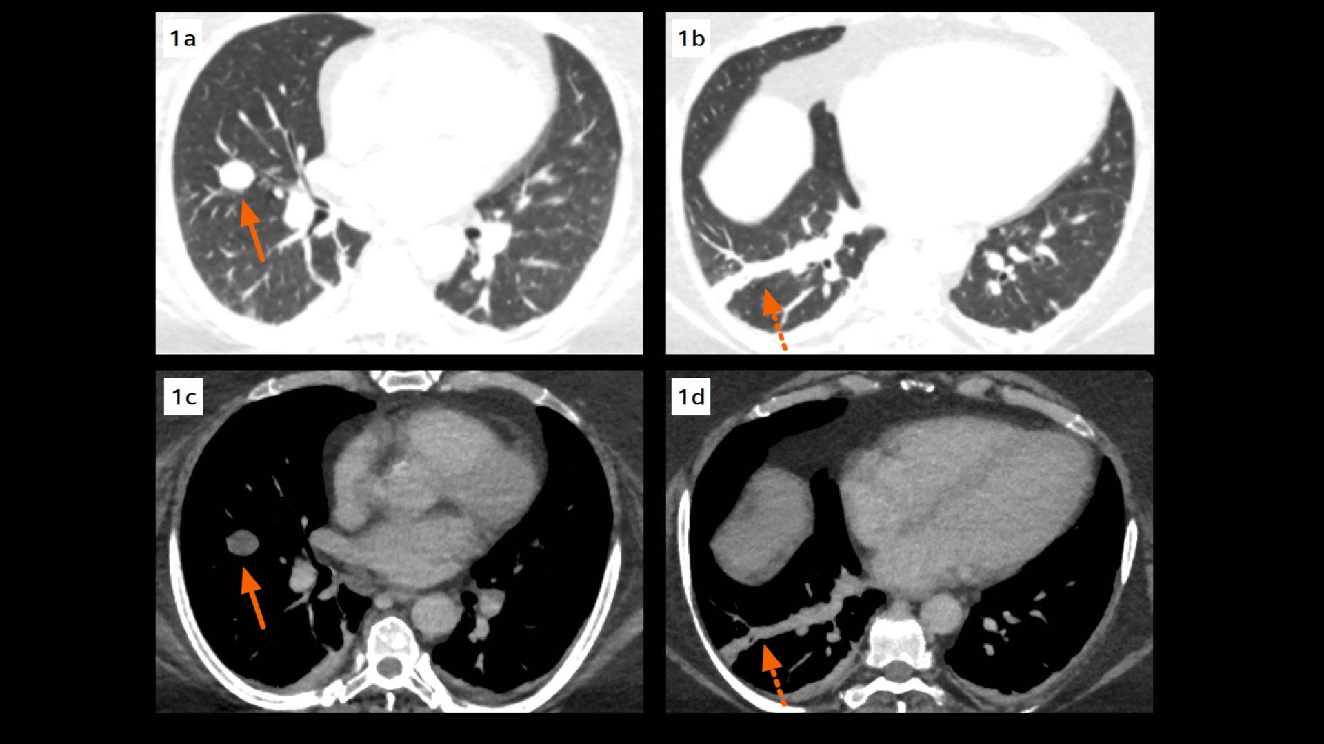 A small pulmonary nodule in an obese patient - Siemens Healthineers