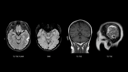 MR imaging in sports medicine - Siemens Healthineers