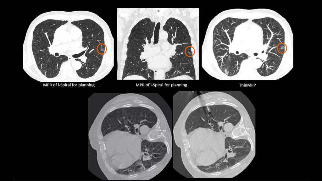 CT-guided interventions - Siemens Healthineers