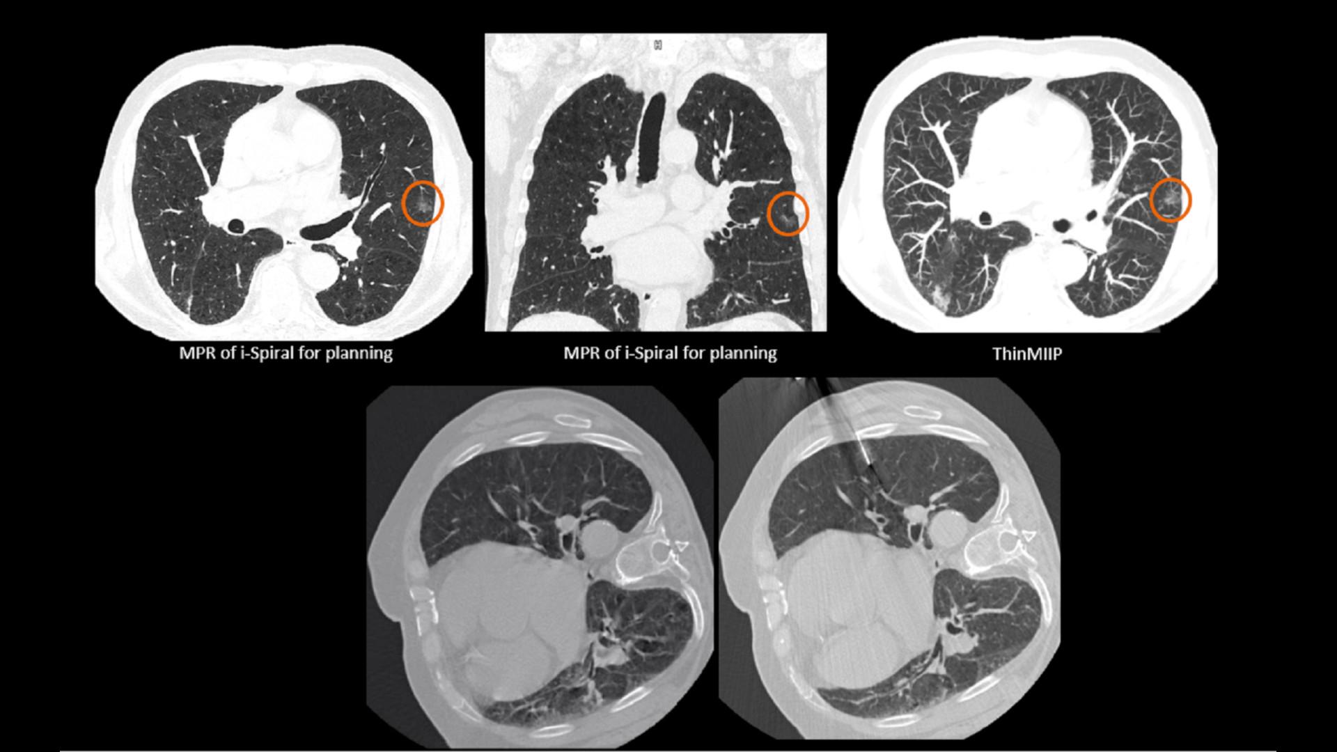 CT-guided interventions - Siemens Healthineers
