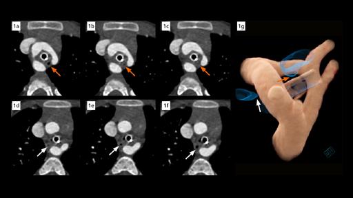 Double aortic arch with esophageal compression - Siemens Healthineers ...