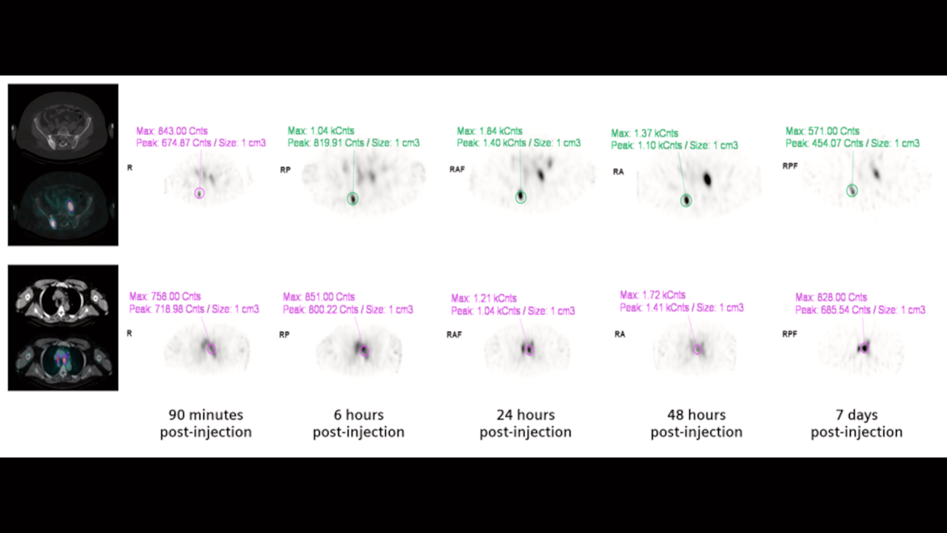 Tumor And Organ Dosimetry From Sequential Quantitative Spectct