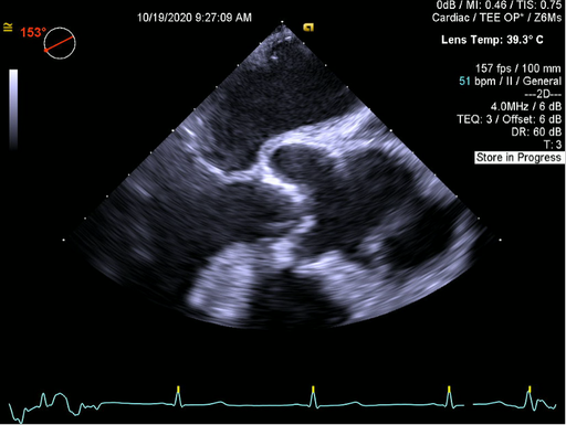 AI and 4D TEE in Aortic Valve Disease