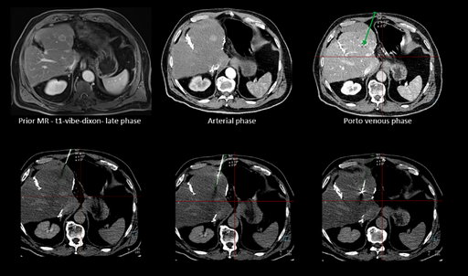 CT-guided interventions - Siemens Healthineers