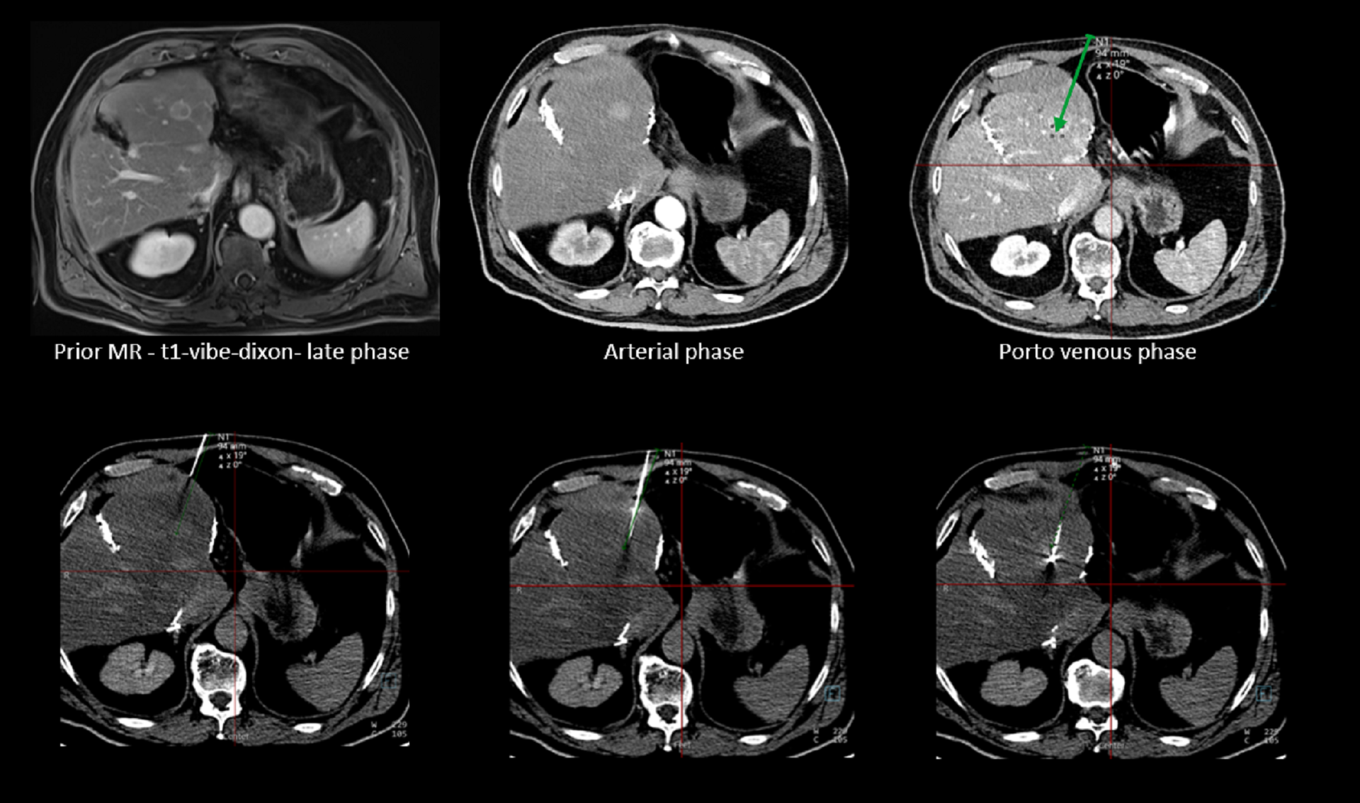 CT-guided interventions - Siemens Healthineers