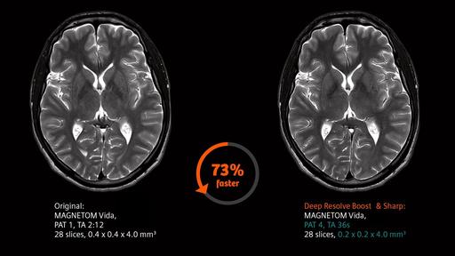 Deep Resolve - Siemens Healthineers
