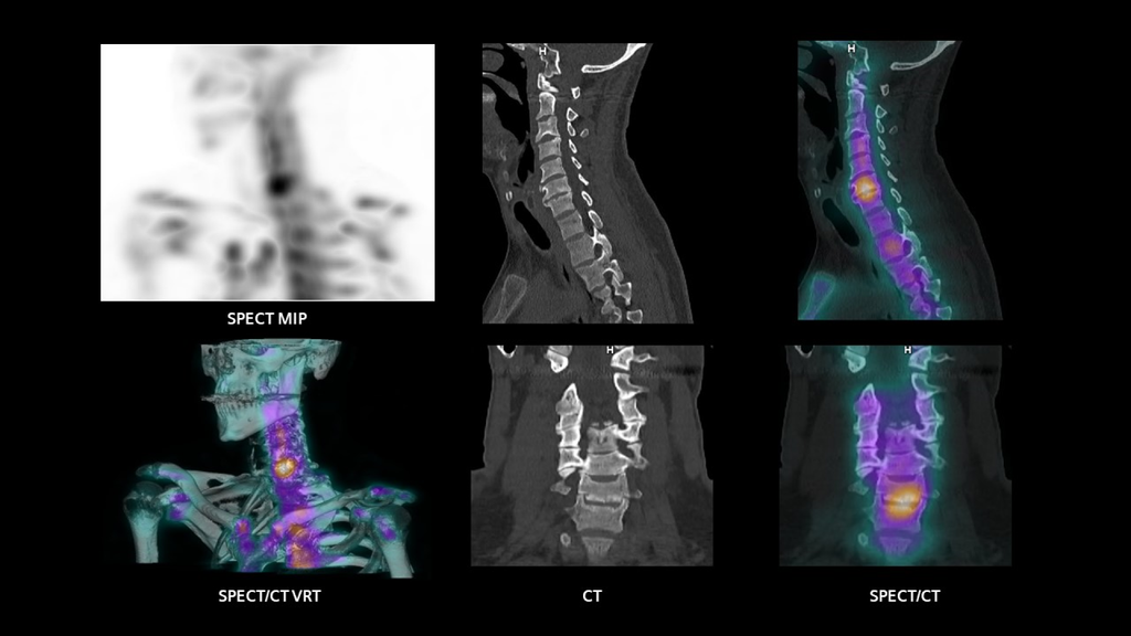SPECT/CT in musculoskeletal medicine - Siemens Healthineers USA