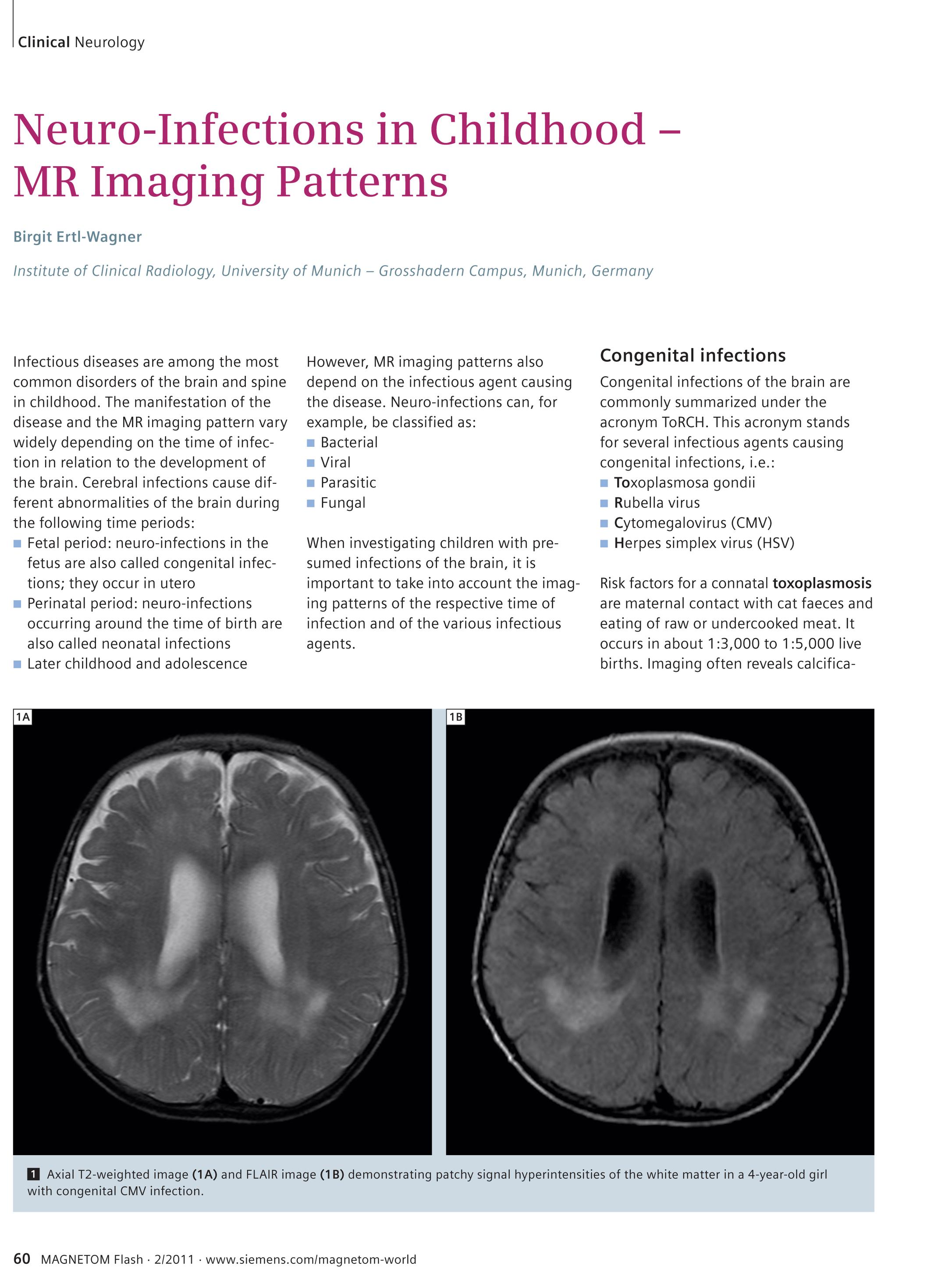 Neuro-Infections in Childhood – MR Imaging Patterns