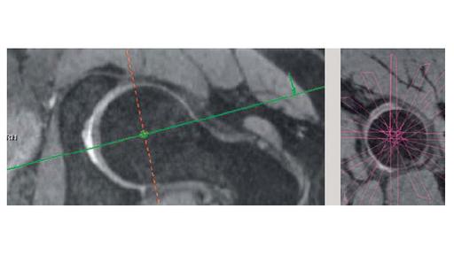 Case Report "Comparison of Acetabular Labrum Lesion and Corresponding ...