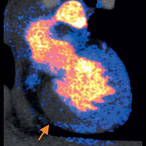 Myocardial Perfusion - Siemens Healthineers España