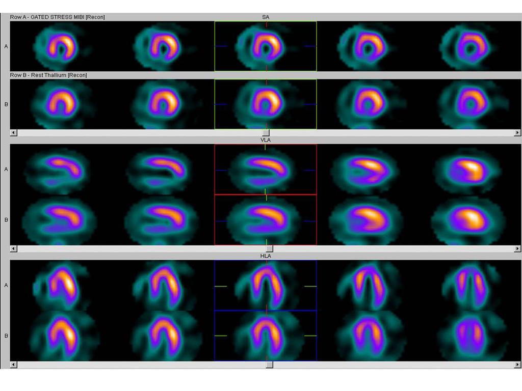 Myocardial Viability - Siemens Healthineers España