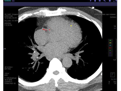 syngo.CT CaScoring - Siemens Healthineers