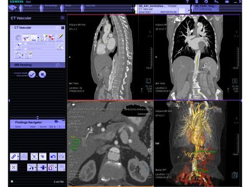 syngo.CT Vascular Analysis - Siemens Healthineers