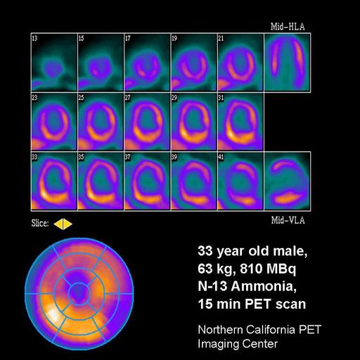 Myocardial Viability - Siemens Healthineers España