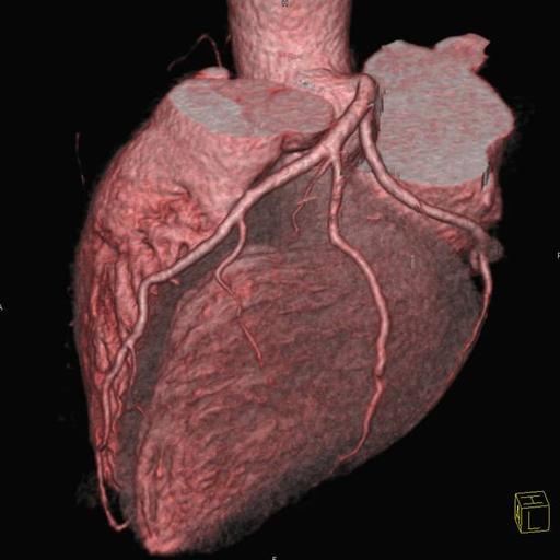 Coronary Imaging - Siemens Healthineers España