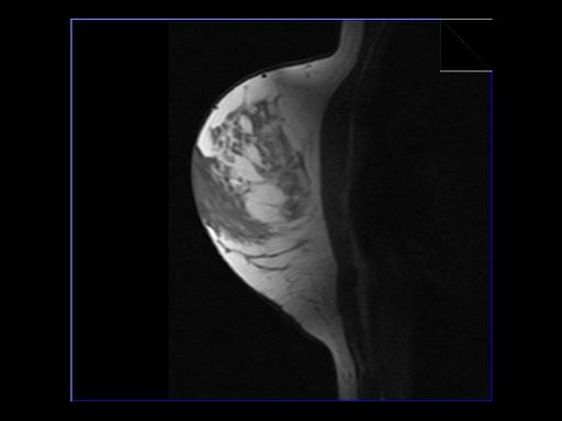 MAGNETOM C! - Breast