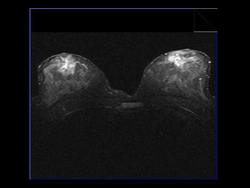 MAGNETOM C! - Breast