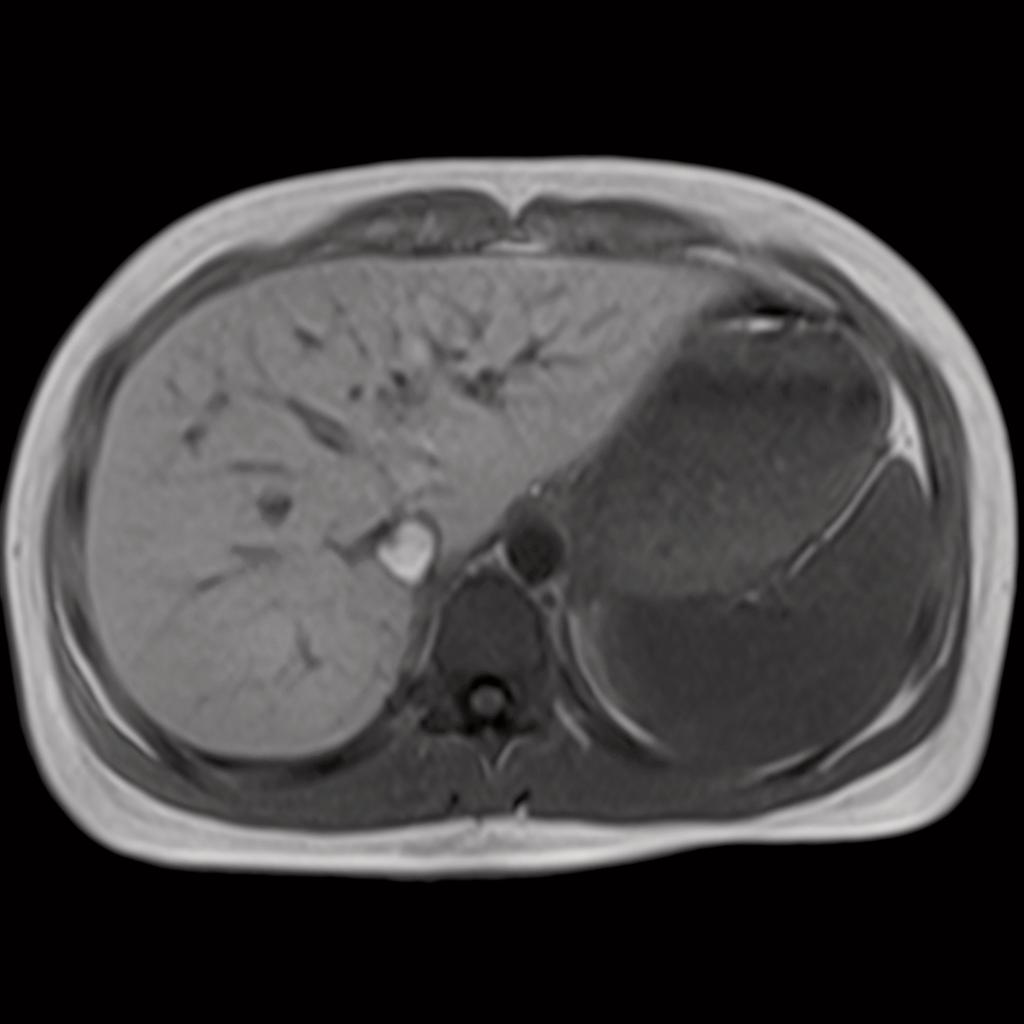 MAGNETOM C! - Abdomen