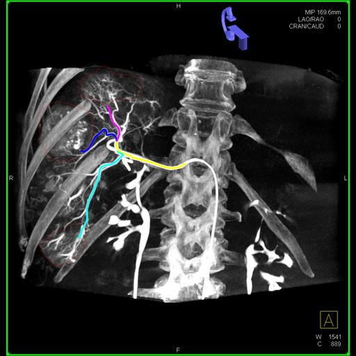 syngo Embolization Guidance - Siemens Healthineers USA