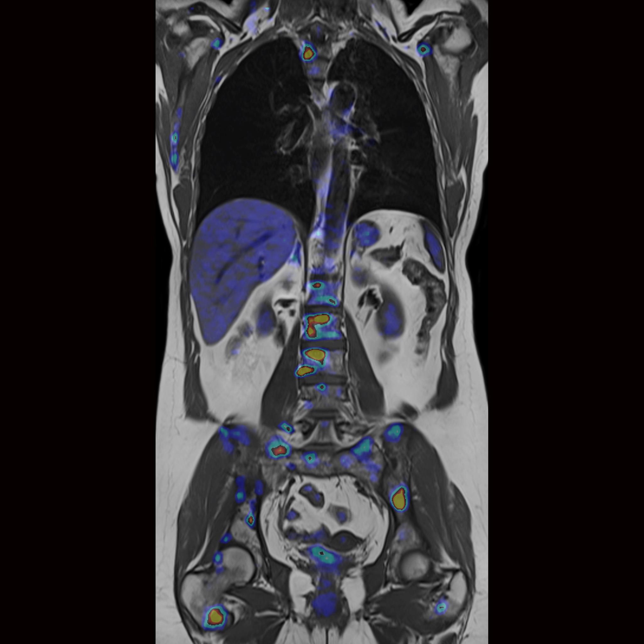 Biograph mMR - Mamma carcinoma with osseous metastases