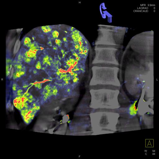 Interventional Oncology - Siemens Healthineers USA
