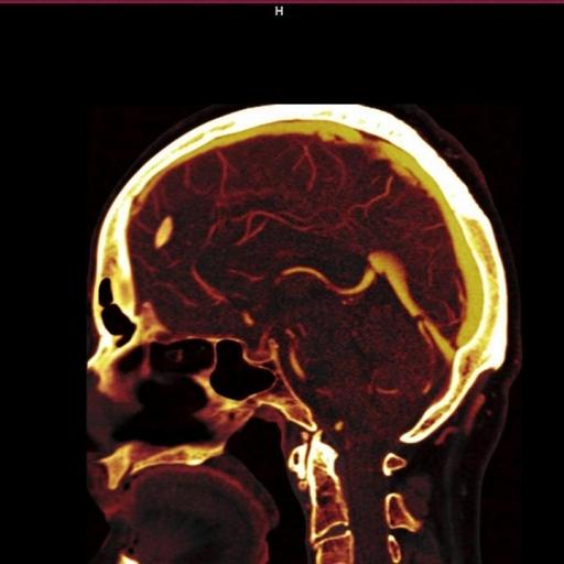 syngo.CT DE Brain Hemorrhage - Siemens Healthineers