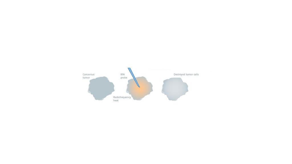 Interventional Oncology - Siemens Healthineers USA
